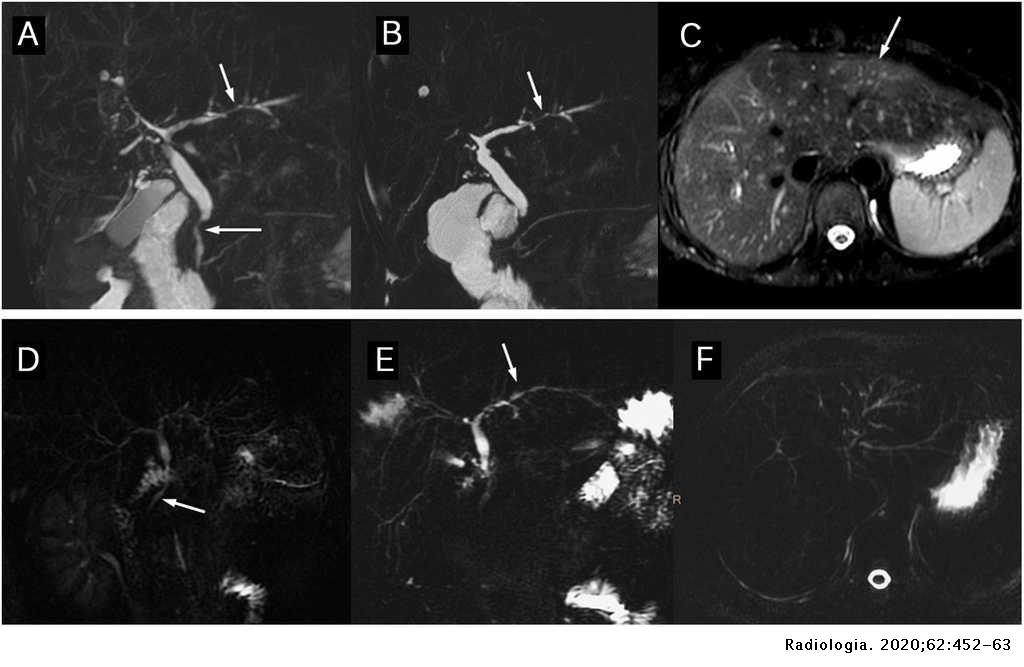 Chronic Cholangitis Differential Diagnosis And Role Of Mri