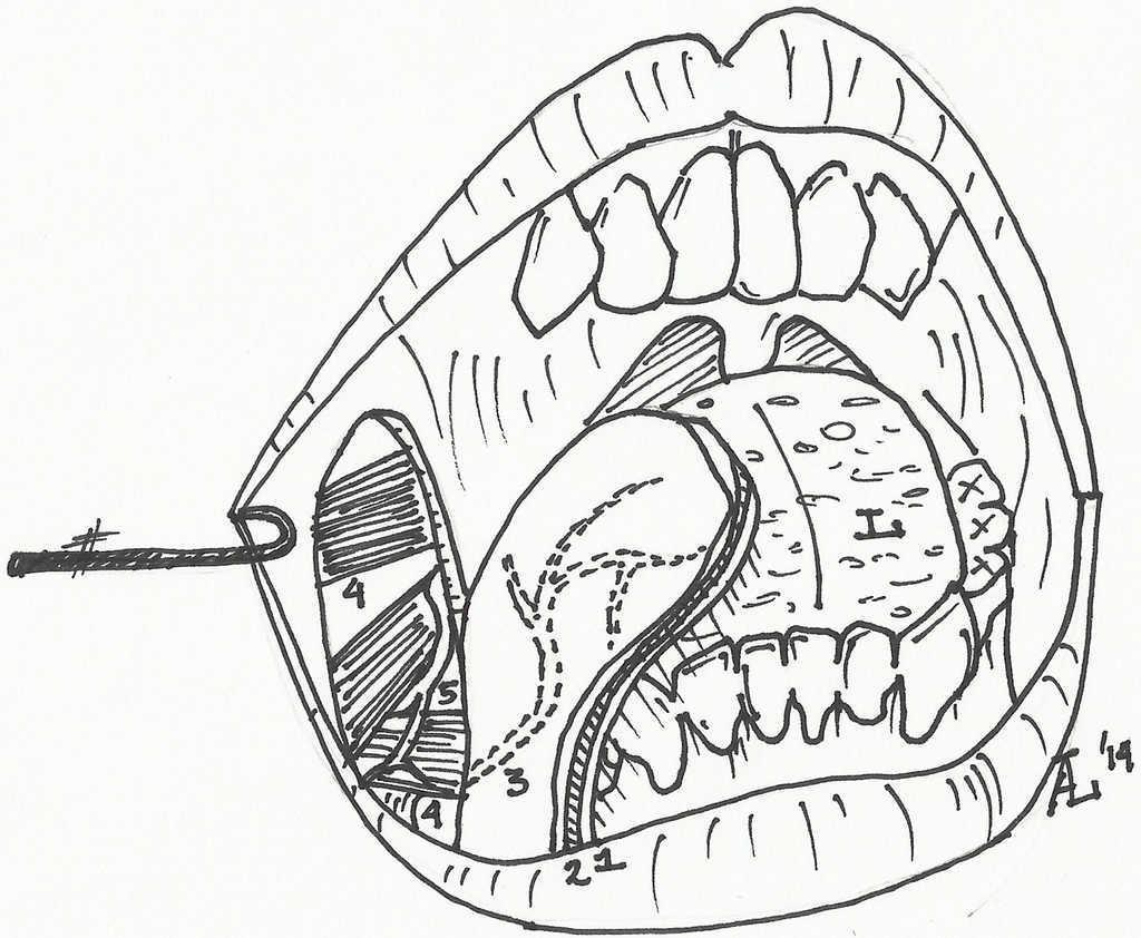 Reconstruction of Oral Cavity Defects With FAMM (Facial Artery ...