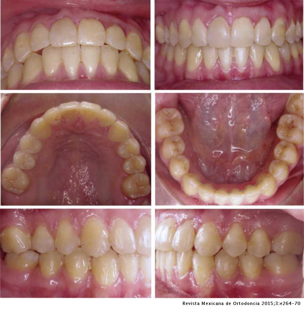 Open Bite Treatment With First Molar Extraction Case Report Revista