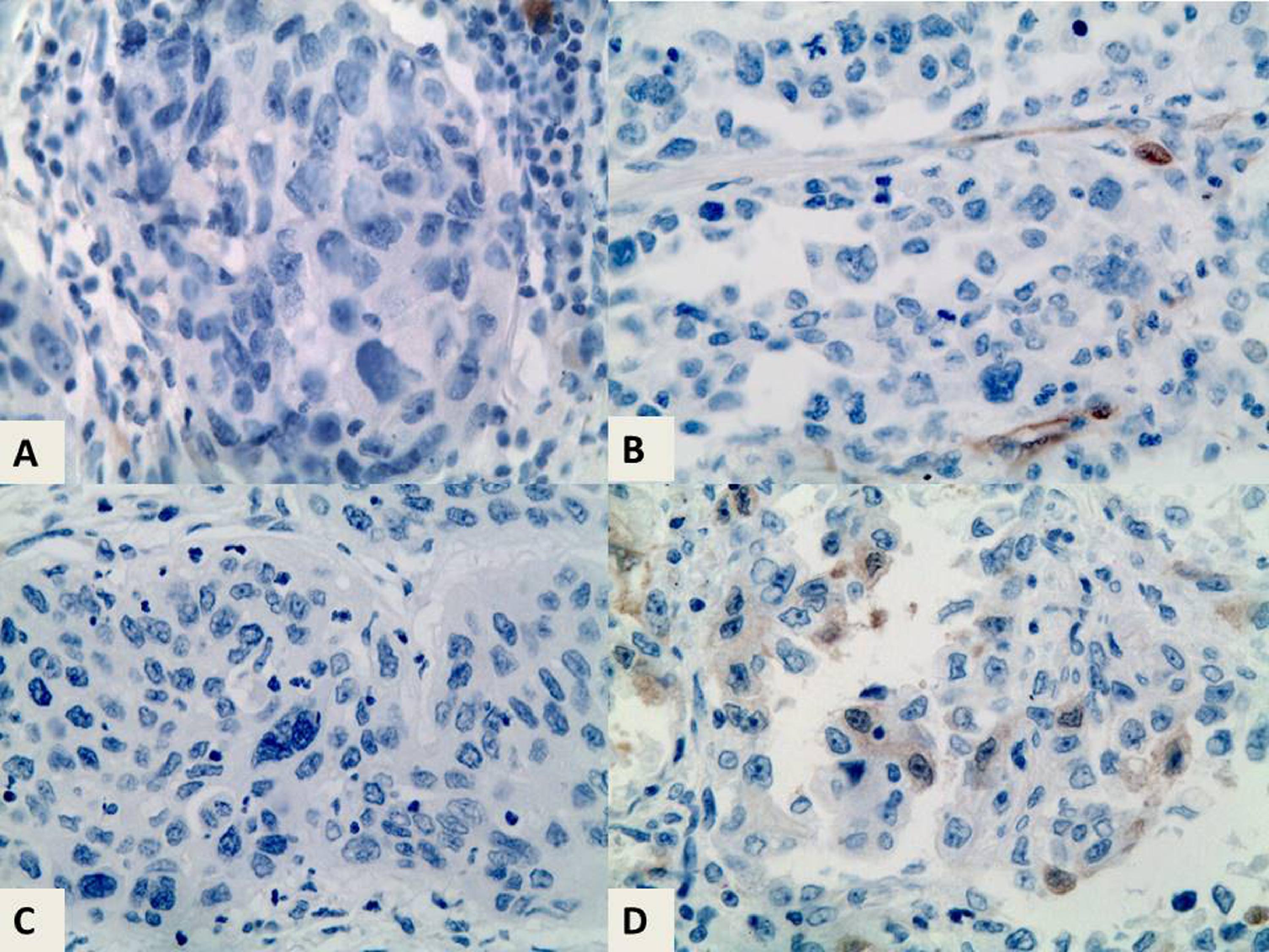Differential immunohistochemical expression of hTERT in lung cancer ...