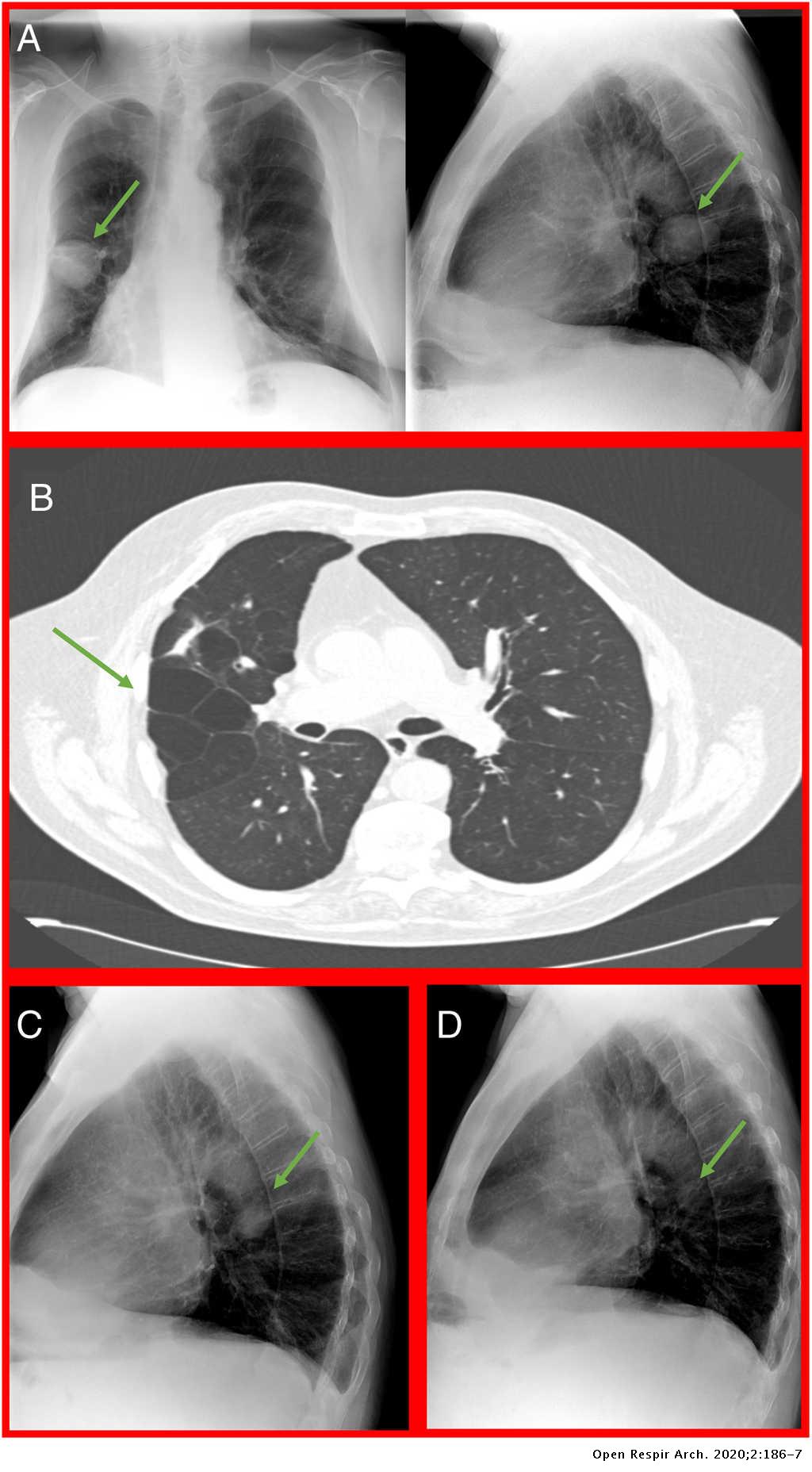 Lung Mass That Responds To Antibiotics Open Respiratory Archives