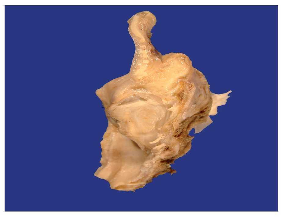 Lipoma de células fusiformes de la laringe: Presentación de un caso y ...