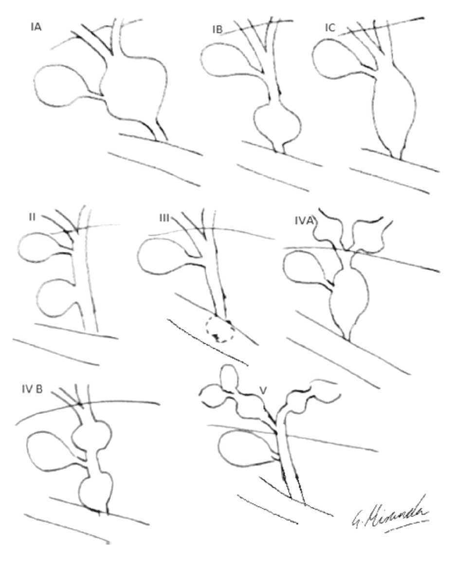 Resección laparoscópica para quiste de colédoco tipo I | Revista Médica ...