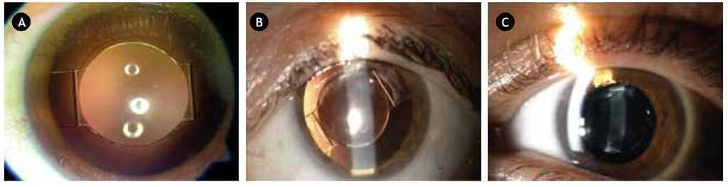 Resultado visual y complicaciones asociadas al implante de Crystalens ...