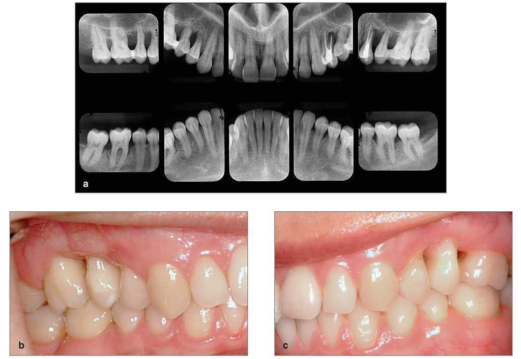 Periodontitis localizada agresiva severa. Progresión de la enfermedad y ...