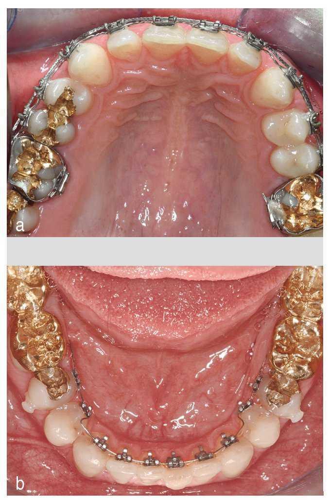 Método labiolingual para el tratamiento sin interferencias: dos casos ...