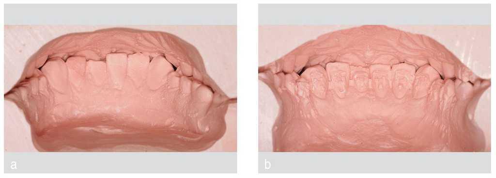 Método labiolingual para el tratamiento sin interferencias: dos casos ...
