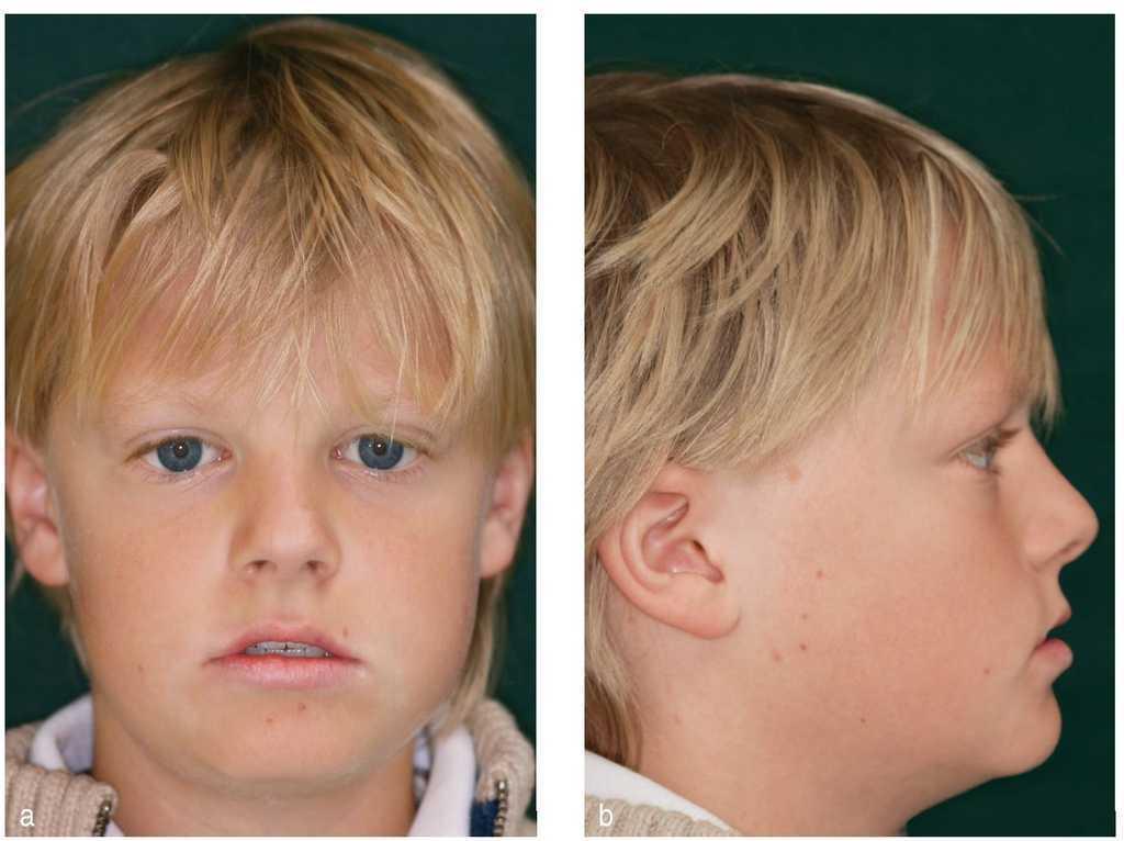 Método labiolingual para el tratamiento sin interferencias: dos casos ...