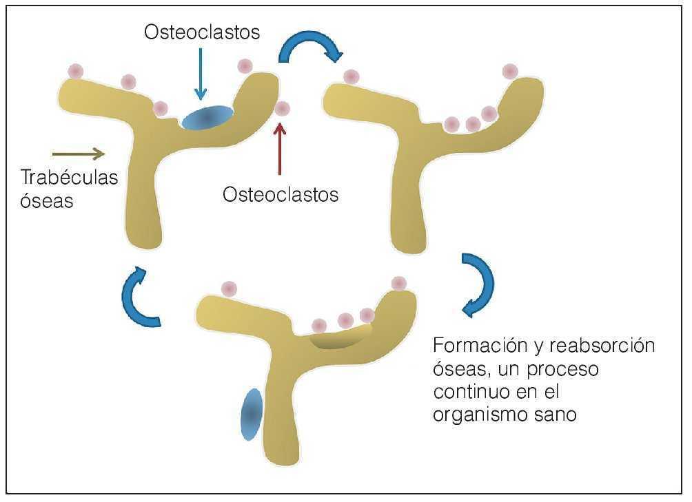 Necrosis de los maxilares asociada a bifosfonatos | Quintessence
