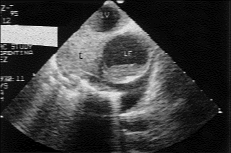 Compresión extrínseca de aurícula izquierda como presentación ...