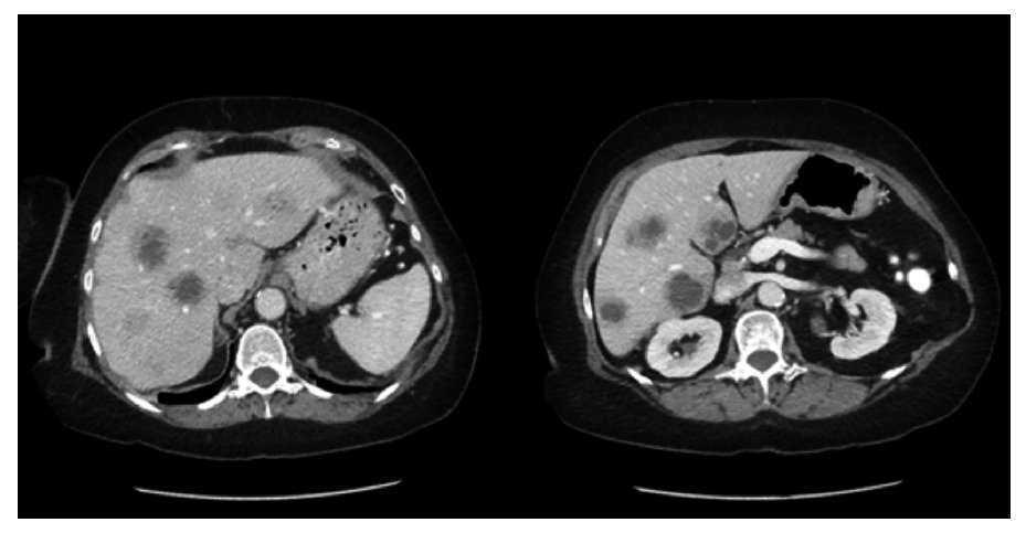 Multiple hepatic abscesses secondary to chicken bone penetration of the ...