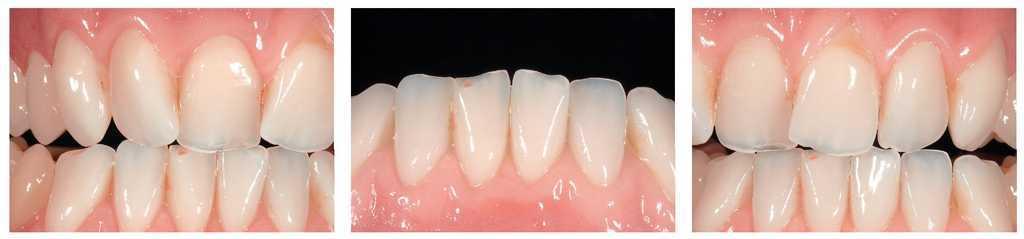 Diente a diente | Quintessence Técnica