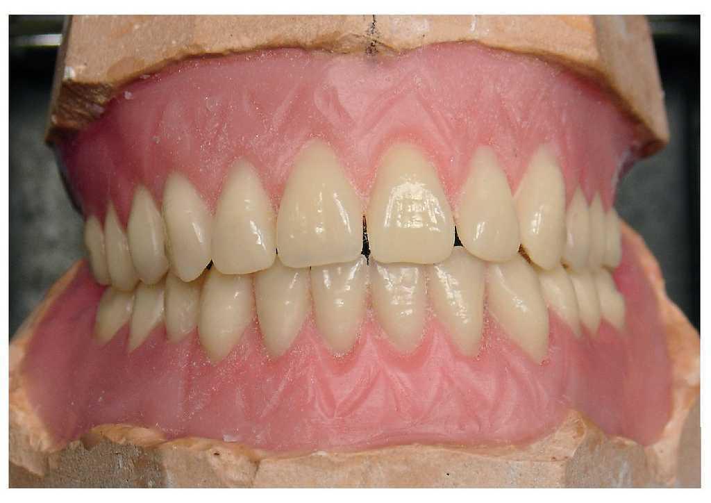 La estética en la prótesis completa. Individualizar la prótesis ...