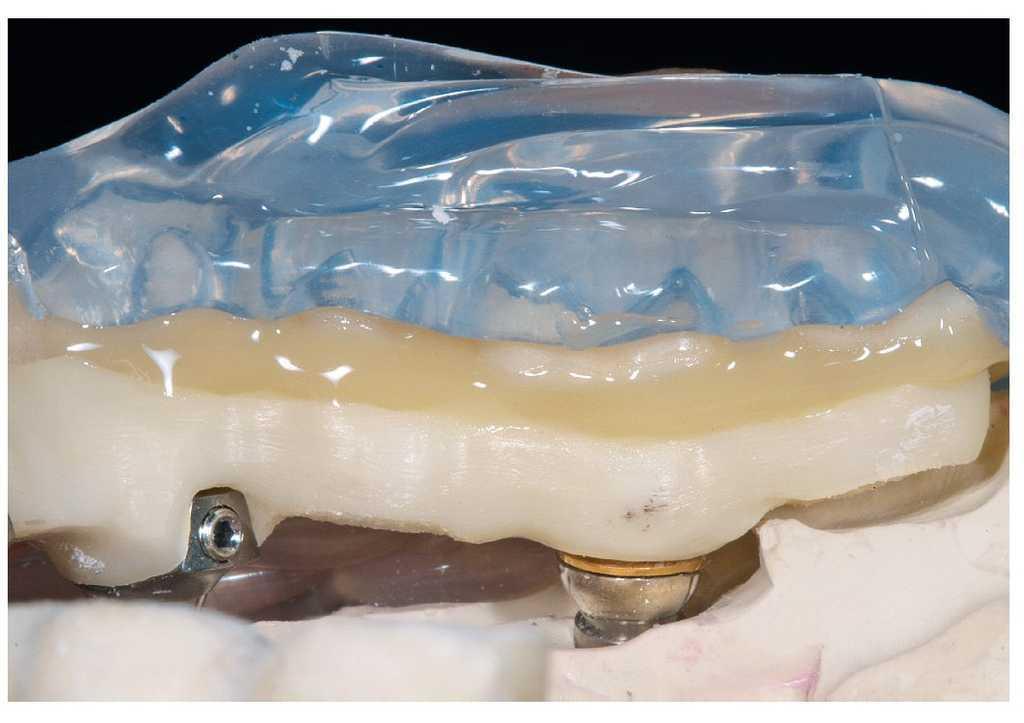 El «puente de Landsberg». Una restauración moderna con dióxido de ...