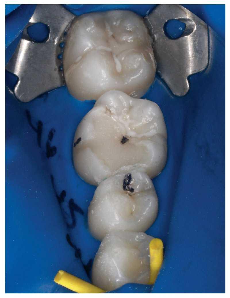 Biomecánica y superficies de masticación de composite | Quintessence ...