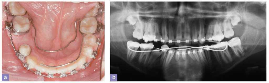 El aparato Lizat para la distalización unilateral de molares en el ...