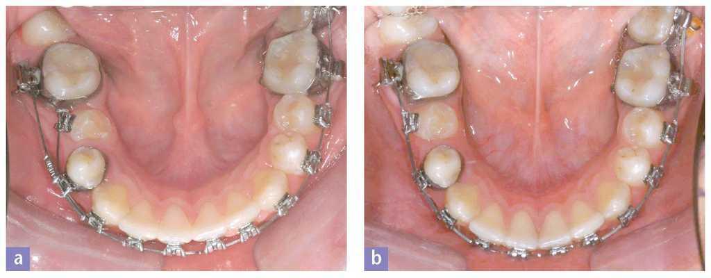 El aparato Lizat para la distalización unilateral de molares en el ...