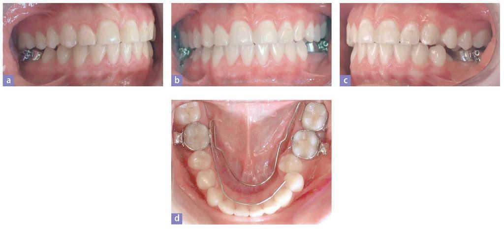 El aparato Lizat para la distalización unilateral de molares en el ...