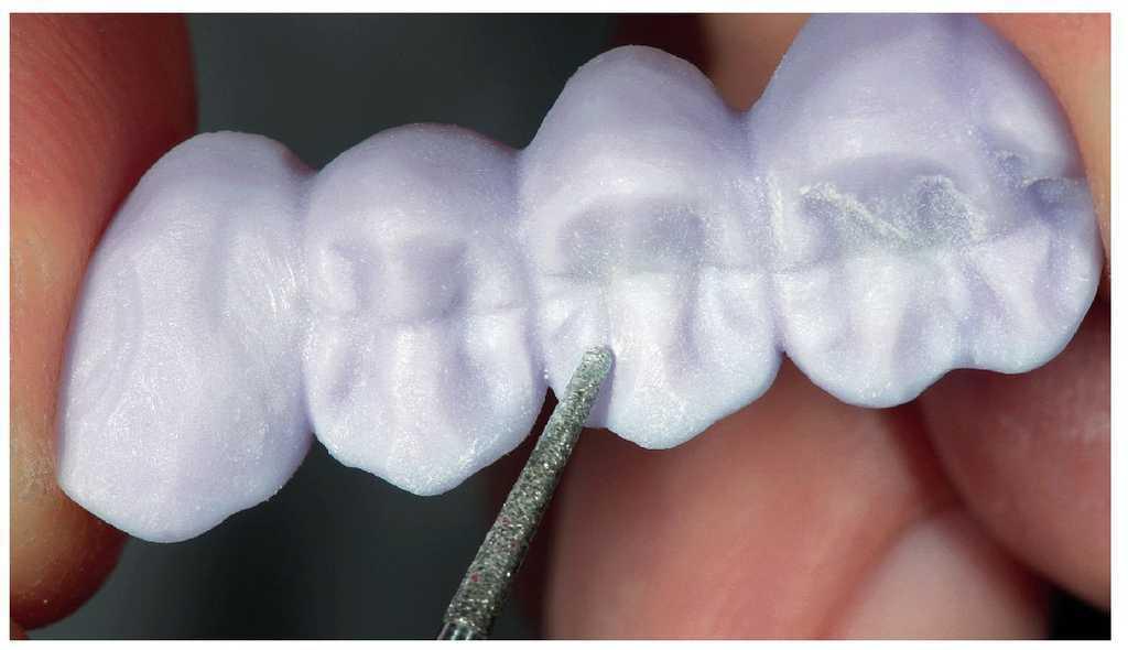 Recubrimiento digital de coronas y estructuras de puentes ...