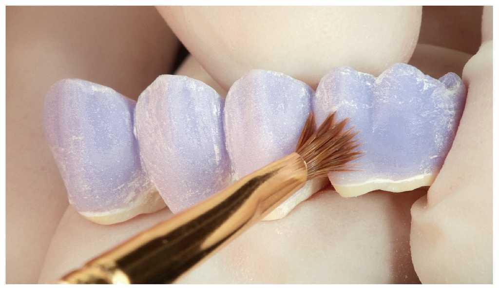 Recubrimiento digital de coronas y estructuras de puentes ...