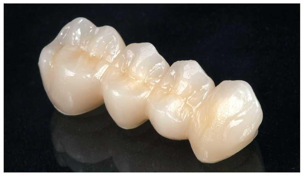 Recubrimiento digital de coronas y estructuras de puentes ...