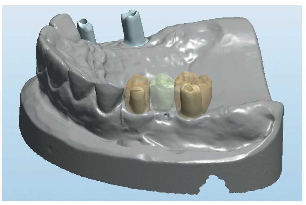 La confección racional de prótesis provisionales de PMMA sobre ...
