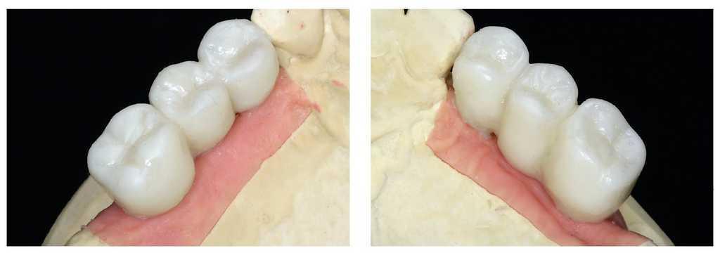 La confección racional de prótesis provisionales de PMMA sobre ...
