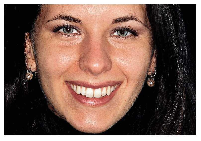 Análisis dentolabial. 1.ª parte: Los labios | Quintessence Técnica