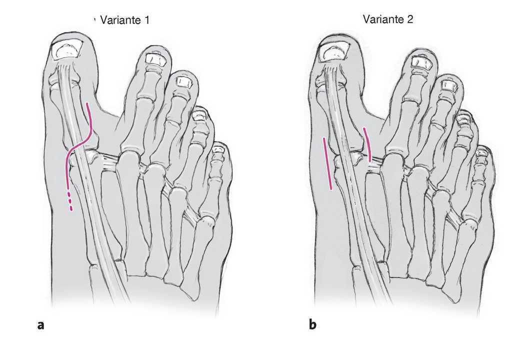 Hemitransposición del tendón del extensor largo en el tratamiento del ...