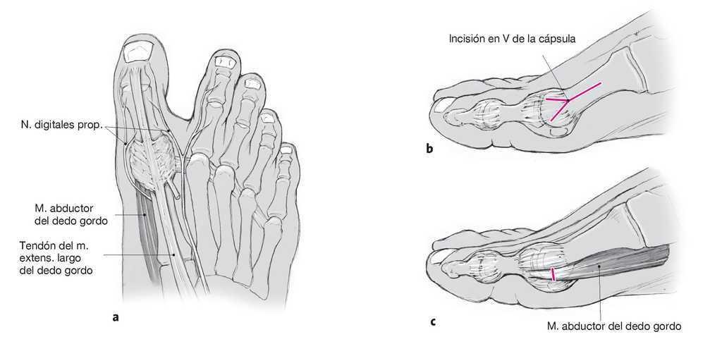 Hemitransposición del tendón del extensor largo en el tratamiento del ...
