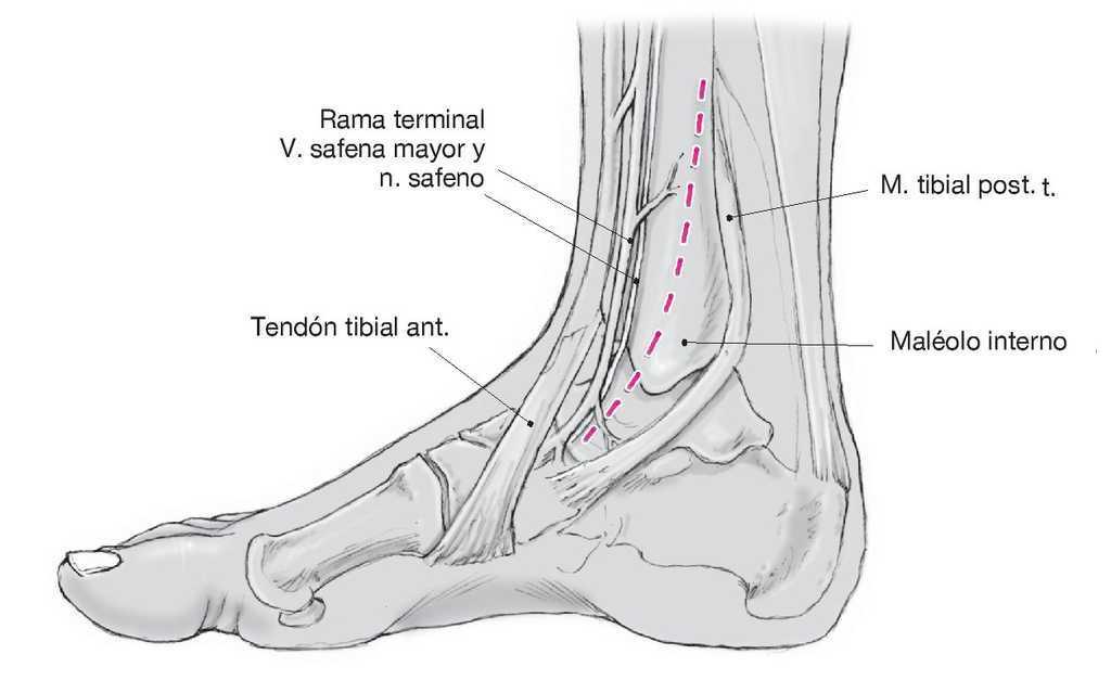 Osteotomía para descarga de la artrosis en varo de la articulación ...