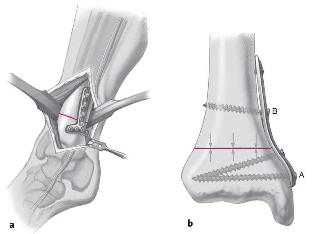Cirugía de realineación en la artrosis de tobillo en valgo | Técnicas ...