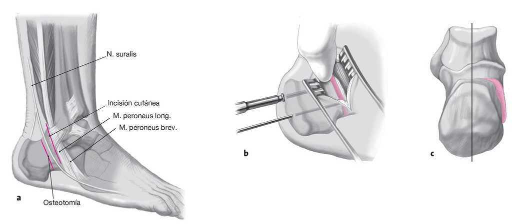 Cirugía de realineación en la artrosis de tobillo en valgo | Técnicas ...