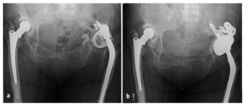 Cotilo modular oblongo para el tratamiento específico de diferentes ...