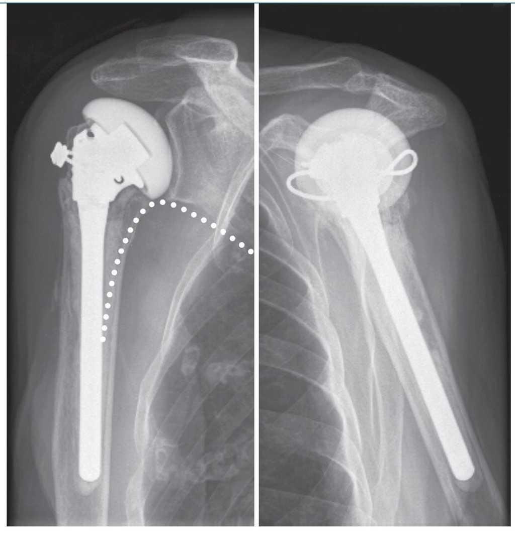 Artroplastia primaria en fractura del húmero proximal con una nueva ...