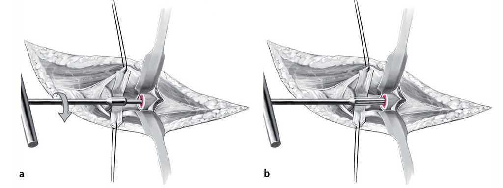 Sustitución endoprotésica de la fractura de la cabeza radial no ...