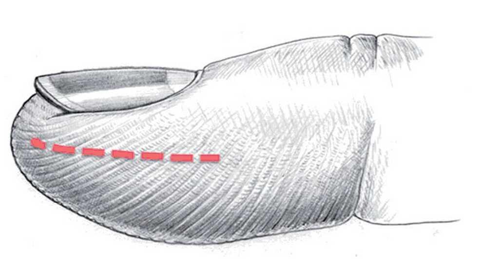 Infección del pulpejo. Panadizo | Técnicas Quirúrgicas en Ortopedia y ...