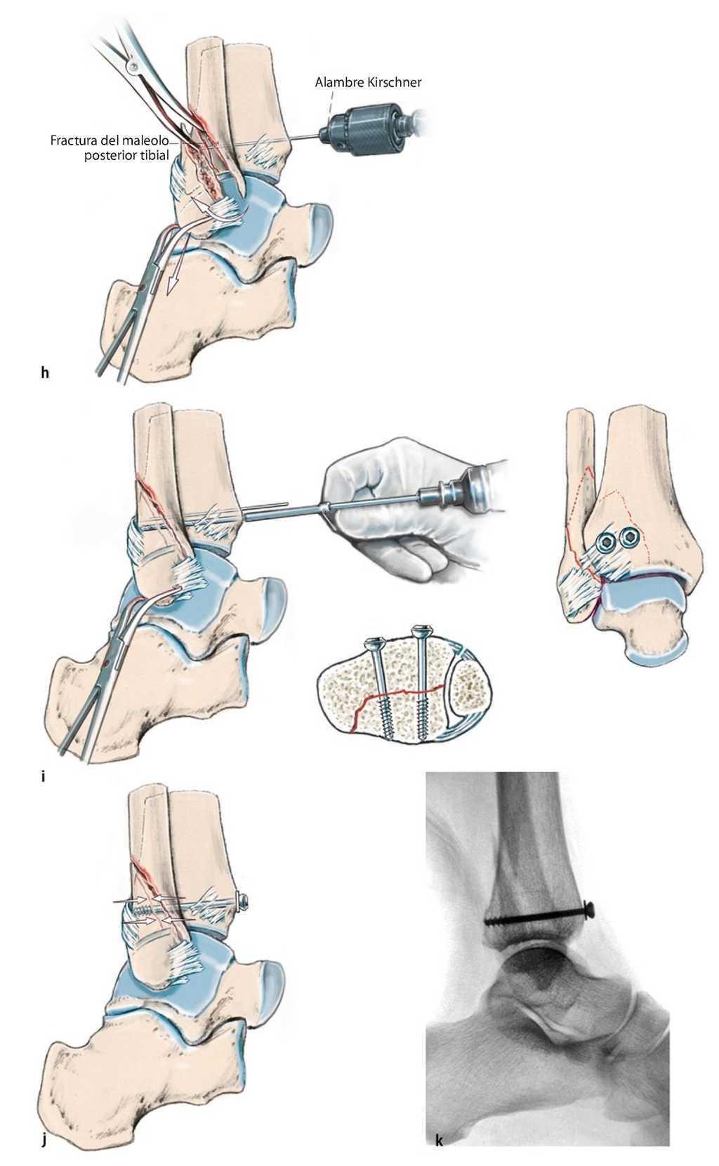 Terapia quirúrgica de las fracturas-luxaciones por pronación de la ...