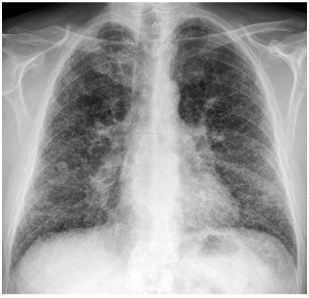 Capítulo 2. Patrón alveolar, intersticial, mixto y lesiones ...