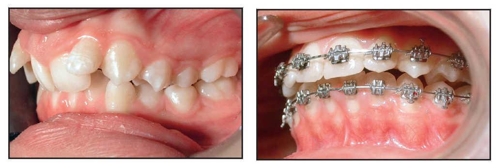 Regeneración de múltiples dehiscencias óseas adyacentes con ...