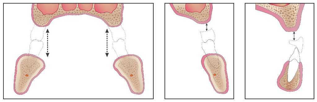 Clasificación de la relación de la cresta alveolar interarcada ...