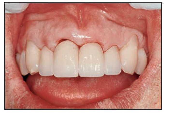 Técnica de preservación de la cresta alveolar con colgajo de rotación ...