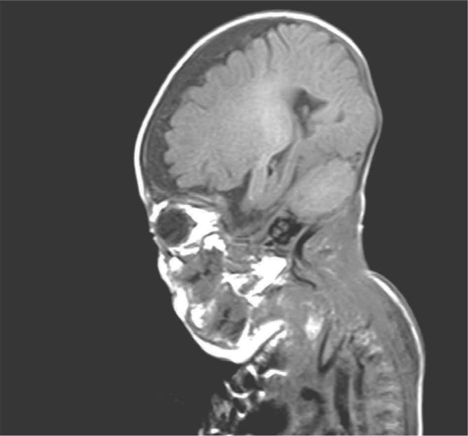 Importancia del binomio corazón-cerebro en el manejo integral de las ...