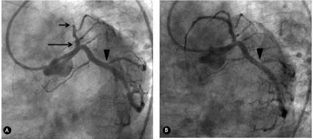 Importancia de la cuantificación del flujo coronario mediante PET. en ...