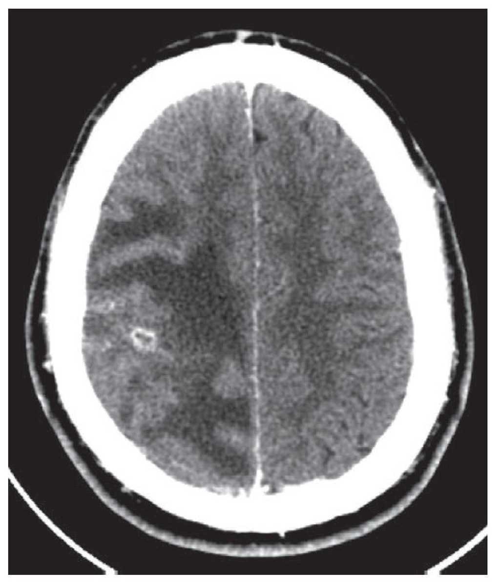 Emerging pathogens in the central nervous system: a cerebral abscess by ...