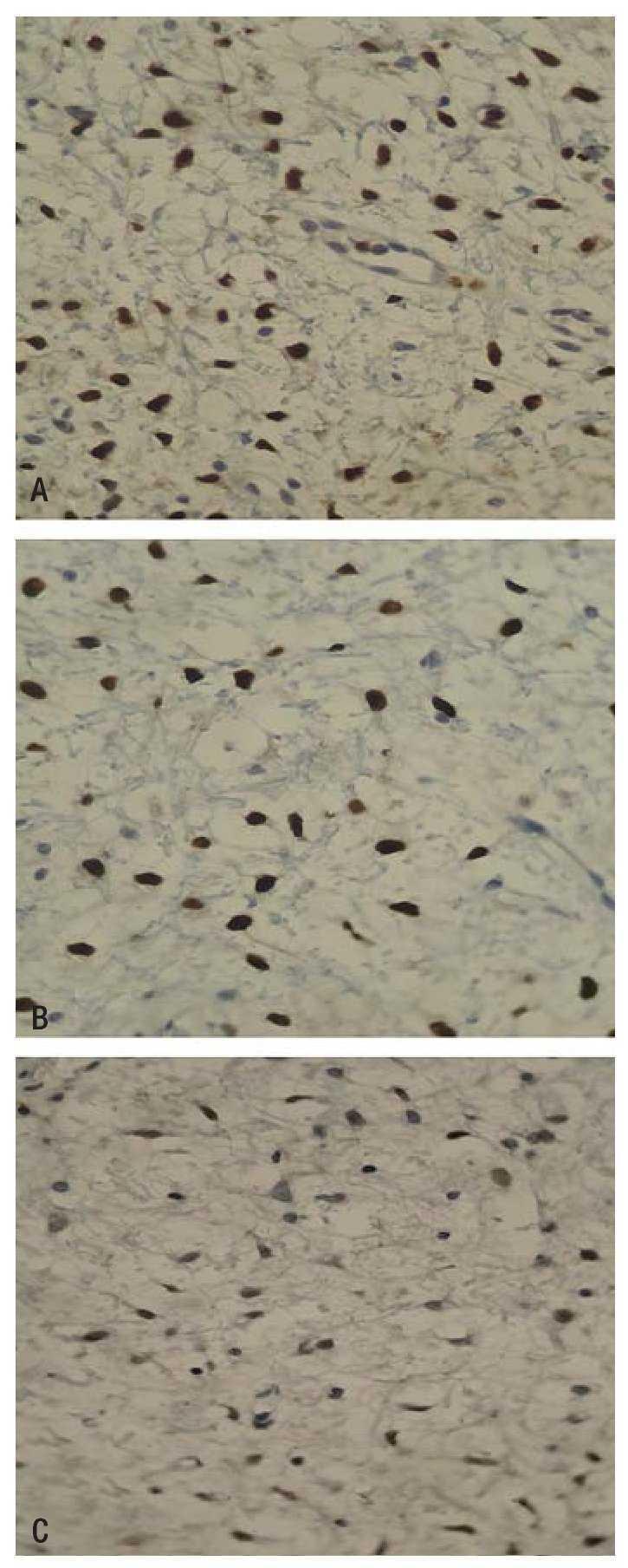 Angiomixoma agresivo vulvoperineal: estudio clínico e ...