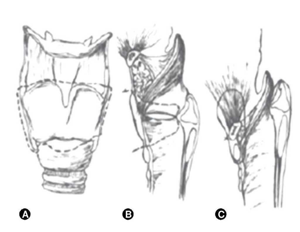 Laringectomía subtotal supracricoidea. La importancia del análisis ...