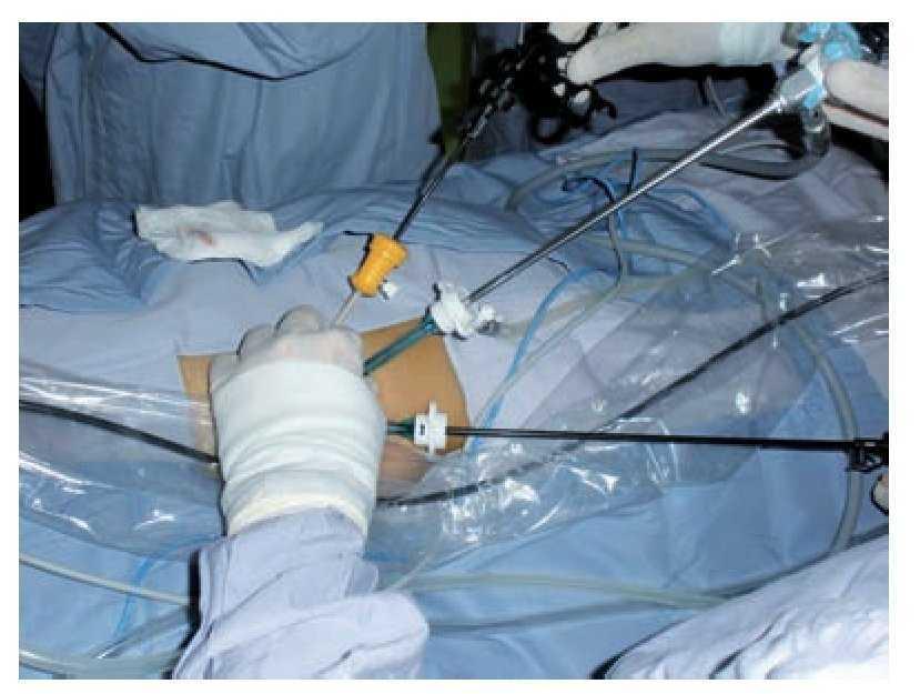 Nefrectomía parcial laparoscópica retroperitoneal posterior en ...