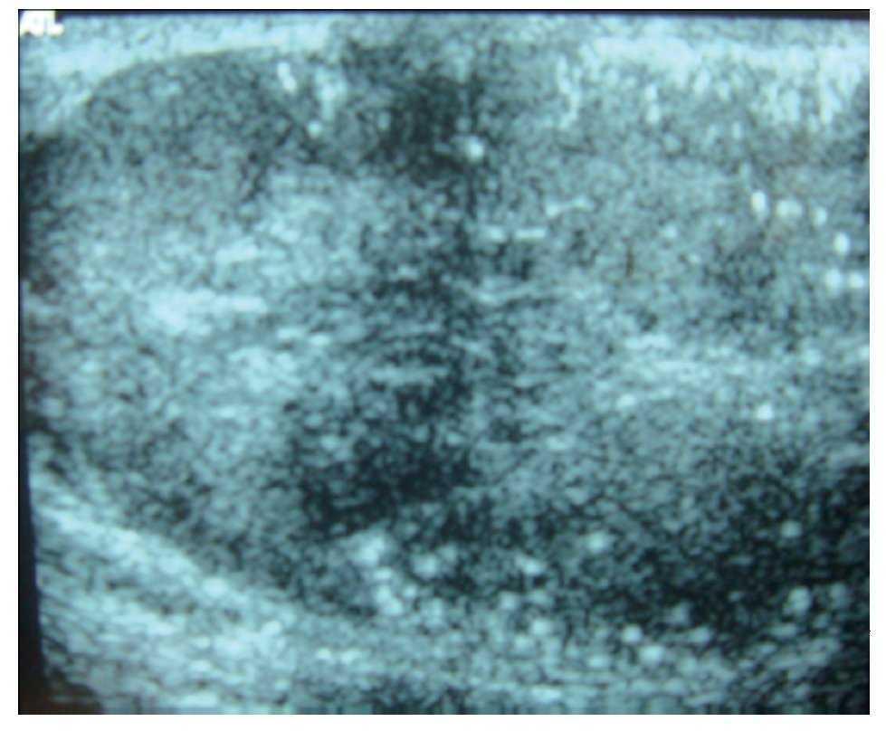 Tumor testicular bilateral metacrónico asociado a microlitiasis ...