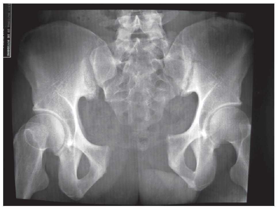 Trauma pélvico con lesión uretral posterior y del cuello vesical ...